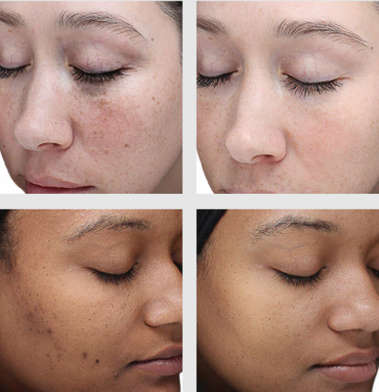 Reveal Radiant, Even-Toned Skin with VI Peel | Medspa of Miami